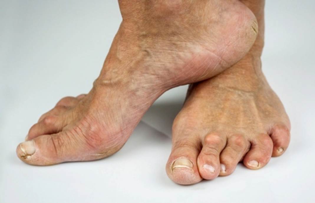 Conditions Treated - Pro Health Podiatry